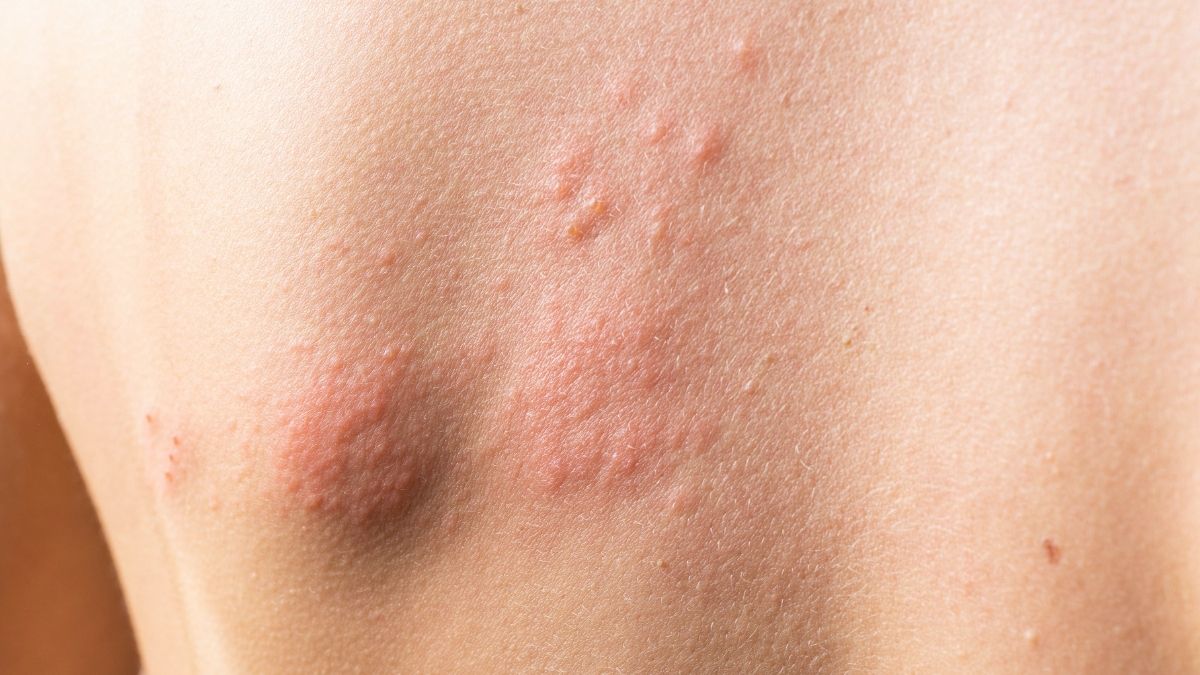 Histamine Intolerance in Winter